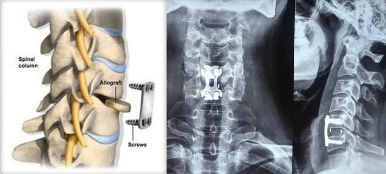 ACDF Surgery in Bangalore | Cervical Spine Experts