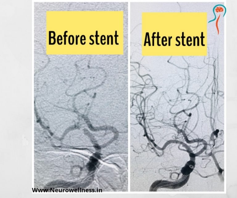 MCA Stenting Minimally Invasive Pin-Hole Brain Surgery