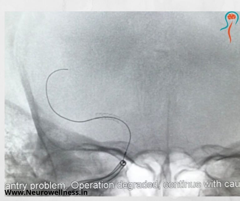MCA Stenting Minimally Invasive Pin-Hole Brain Surgery