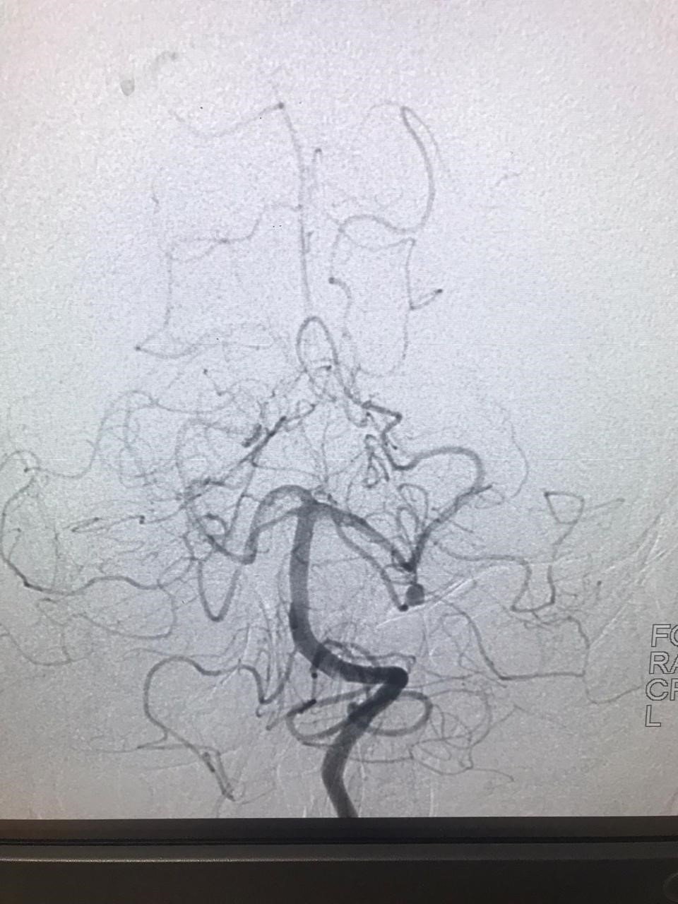 Endovascular Coiling of Superior Cerebellar Aneurysm