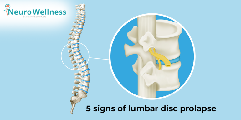 Lumbar Disc Prolapse Symptoms & Treatment in Bangalore