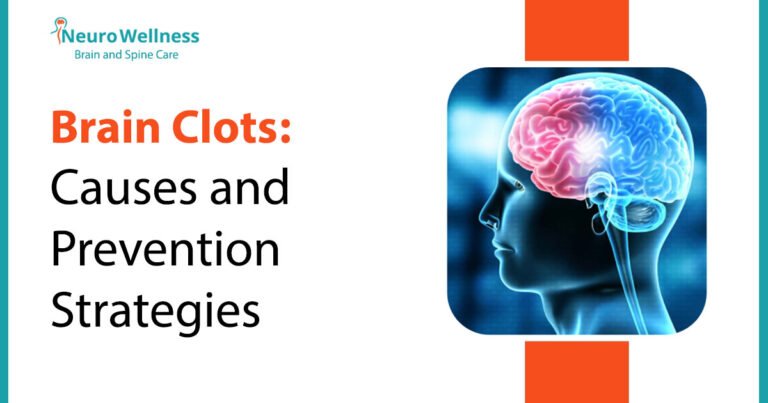 Brain Clots: Causes & Prevention Strategies | NeuroWellness