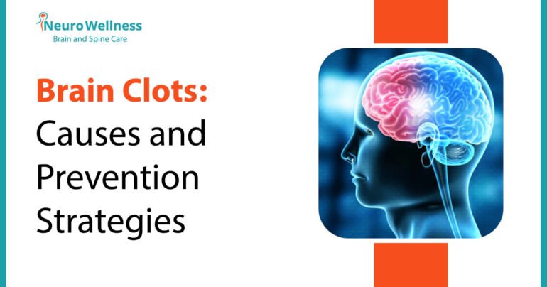 Brain Clots: Causes & Prevention Strategies | NeuroWellness