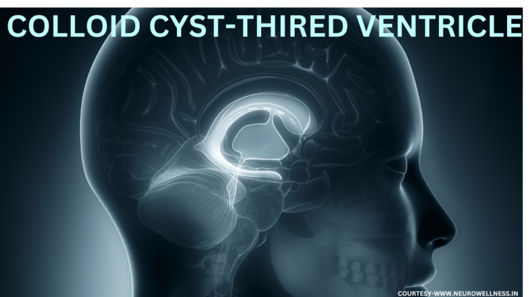 Surgical Management of Colloid Cyst of Third Ventricle
